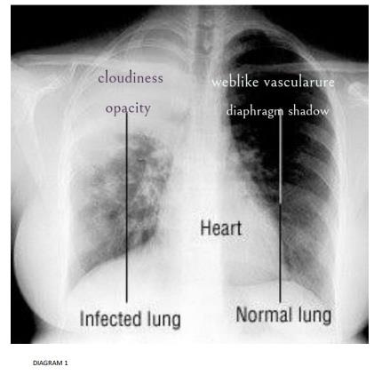Pneumonia Disease Causes and Treatment